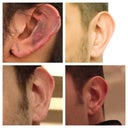 Conchal Bowl Ridges After Bilateral Otoplasty... Doctor Answers, Tips