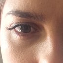 How to fix my under eyes? Young, in 20s. Is it orbital fat loss? Did my ...