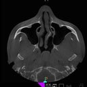 Once a broken septum has healed, can it be re-broken and set straight ...