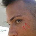 Correcting Creases Where Cheek and Under Eye Meet/eye Hollow in the ...