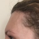 Fat Graft for Asian Forehead? (photo) Doctor Answers, Tips