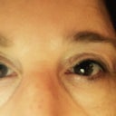 Why Are my Eyelids Uneven? Why is One Eye Crease Deeper Than the Other ...