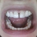 Could I Be a Candidate for Invisalign Express 10? (photo) Dentist ...