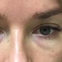 Blepharoplasty Transconjunctival vs Skin Pinch/Incision? (photos ...