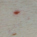 Inflamed Mole Biopsy. Is it Common to Send Back to Pathologist to ...