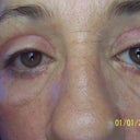 Upper and Lower Eyes and Full Face Dermabrasion - Eyelid Surgery review ...