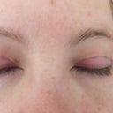 Very Worried About Webbing at Inner Corners of Eyes and Very Thick Scar ...