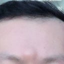 Is it possible to remove hard lump on forehead caused by bumping head ...