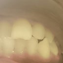 What can I do to fix a protruding front tooth? (Photo) Doctor Answers, Tips