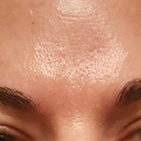 Dent between my eyebrows. Botox and fillers have not helped. (photo ...