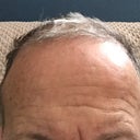 How common is the mid-forehead lift? in figure 1(photos) Doctor Answers ...