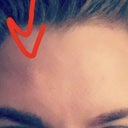 After I have Botox I seem to get horn style lumps over both ends of my ...