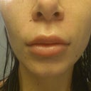 Options To Correct Larger Space Between the Upper Lip and Nose After ...