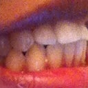 Can Invisalign Fix my Slanted Front Teeth? (photo) Dentist Answers, Tips