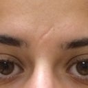 What are realistic options for revision of a 22 y/o diagonal indented ...