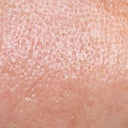 Fraxel - Bad Results - Bad Skin Texture - Review - RealSelf