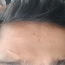 Wondering About Having 2 Small Horizontal Indented Scars Filled Across ...