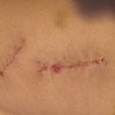 How to Remove Scars from Staph Infection? (photo) Doctor Answers, Tips