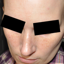 TCA 25% Peel With Uneven Frosting, How To Improve Results? (photo ...