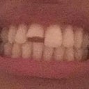 Front tooth broken in half due to trauma. What are my options? Will I ...