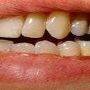 Can a crowned tooth over-erupt / hyper-erupt? (photos) Doctor Answers, Tips