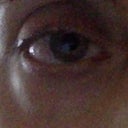 What can reduce the appearance of a negative vector eye & A-frame ...