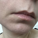 Botox on the Depressor Anguli Oris? Doctor Answers, Tips