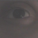 What Filler for Outer/corner Eye Hollow (Not Tear Trough) Would Work ...