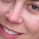 Cheek Dents Becoming More and More Pronounced? (photo) Doctor Answers, Tips