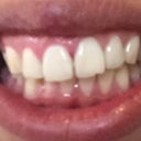 Can Invisalign Fix my Slanted Front Teeth? (photo) Dentist Answers, Tips