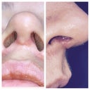 Columella Scar - I'm Worried About It? (photo) Doctor Answers, Tips