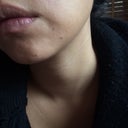 Is 21 too young for laugh line fillers? Doctor Answers, Tips