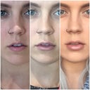 What is the the difference between Volift and Volbella for lip ...