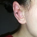 Conchal Bowl Ridges After Bilateral Otoplasty... Doctor Answers, Tips