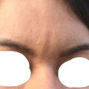 Dent between my eyebrows. Botox and fillers have not helped. (photo ...