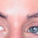 Orbital rim shaving - Review - RealSelf