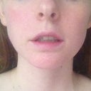 Lip Incompetence and Mentalis Strain- Easiest Way to Fix? (photo ...