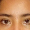 Enophthalmos And/or Hypoglobus After Orbital Floor Fracture? (photo ...