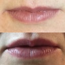 Permalip - Charleston, SC - Lip Augmentation review - RealSelf