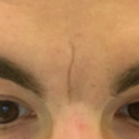 Bulging Temple Veins Bilaterally? (photos) Doctor Answers, Tips