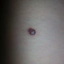 I have a crusty mole on my back. Should I be worried? (Photo) Doctor ...