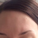 Lumps on forehead after Botox injections? When will they go away ...