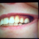 Does these symptoms suggest an ill fitting crown? (photo) Doctor ...