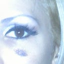 Will my Under Eye Bruise After Juvederm Become a Hemosiderin Stain ...