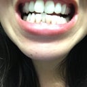 Black Triangle Solution? Now in Braces Treatment...HELP? (photo ...