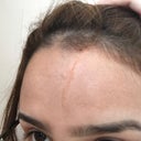 I have an indented forehead scar from a childhood accident. Is there ...