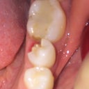 Tooth Broken to the Gum Line Doctor Answers, Tips
