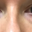 Blepharoplasty Transconjunctival vs Skin Pinch/Incision? (photos ...