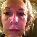 Recurrent Swelling 4 Months After Restylane to Tear Troughs? (photo ...