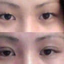 Upper and Lower Eyes Surgery, Day 18: The deep scars are my concern ...